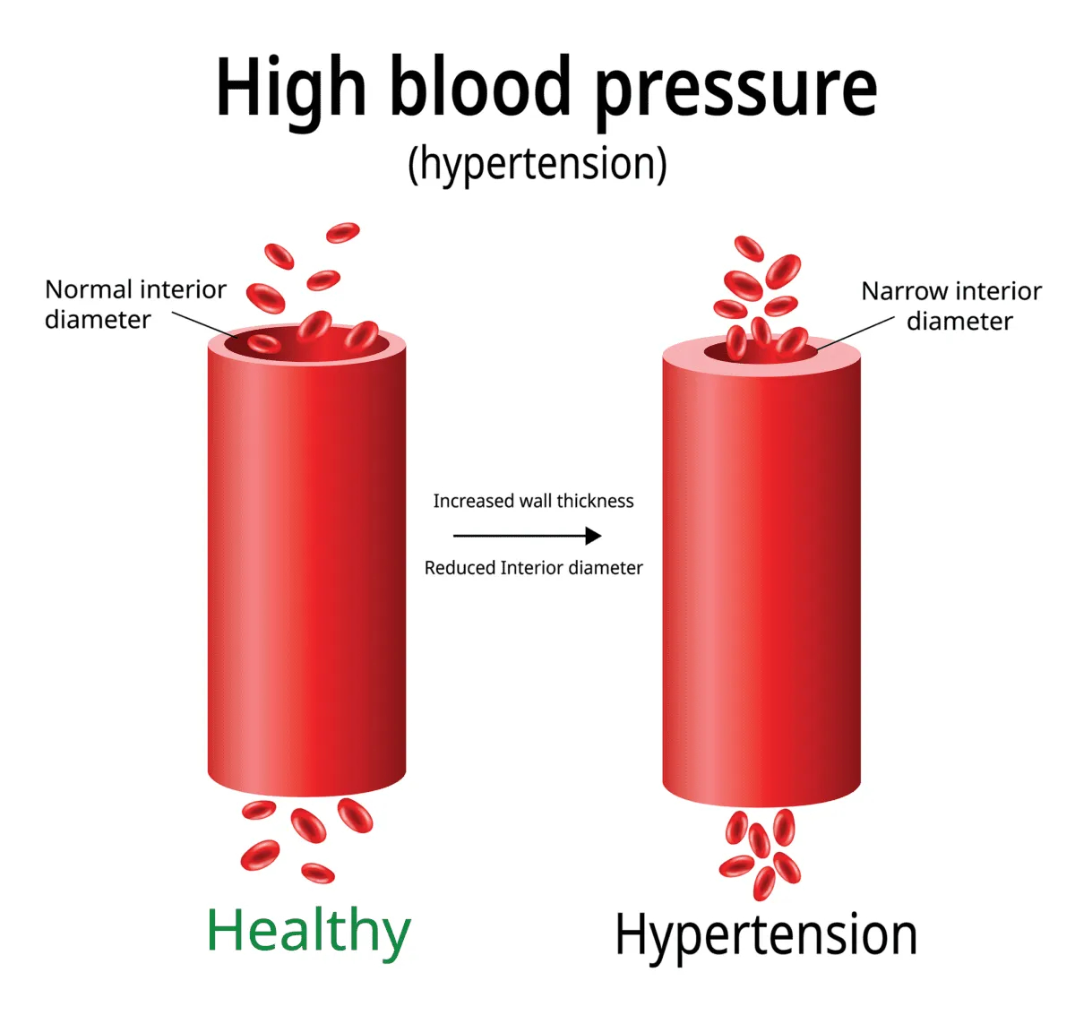 How To Manage High Blood Pressure | Healthier Matters